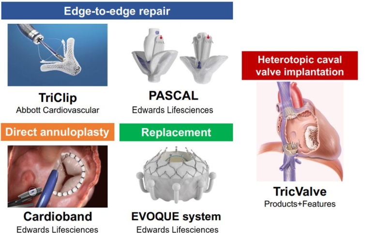 Tricuspid regurgitation – Part 2: treatment options